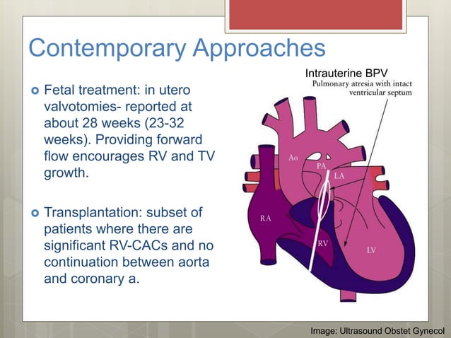 Pulmonary atresia with intact interventricular septum management | PPTX ...