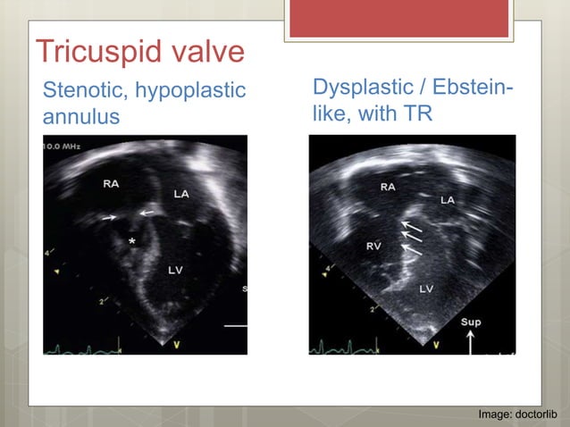 Pulmonary atresia with intact interventricular septum management | PPTX ...