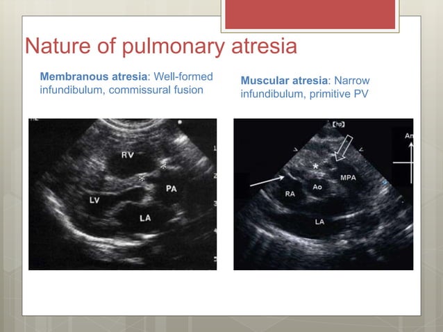 Pulmonary atresia with intact interventricular septum management | PPTX ...