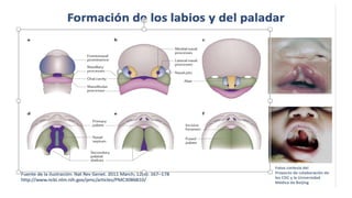 Paladar hendido | PPTX
