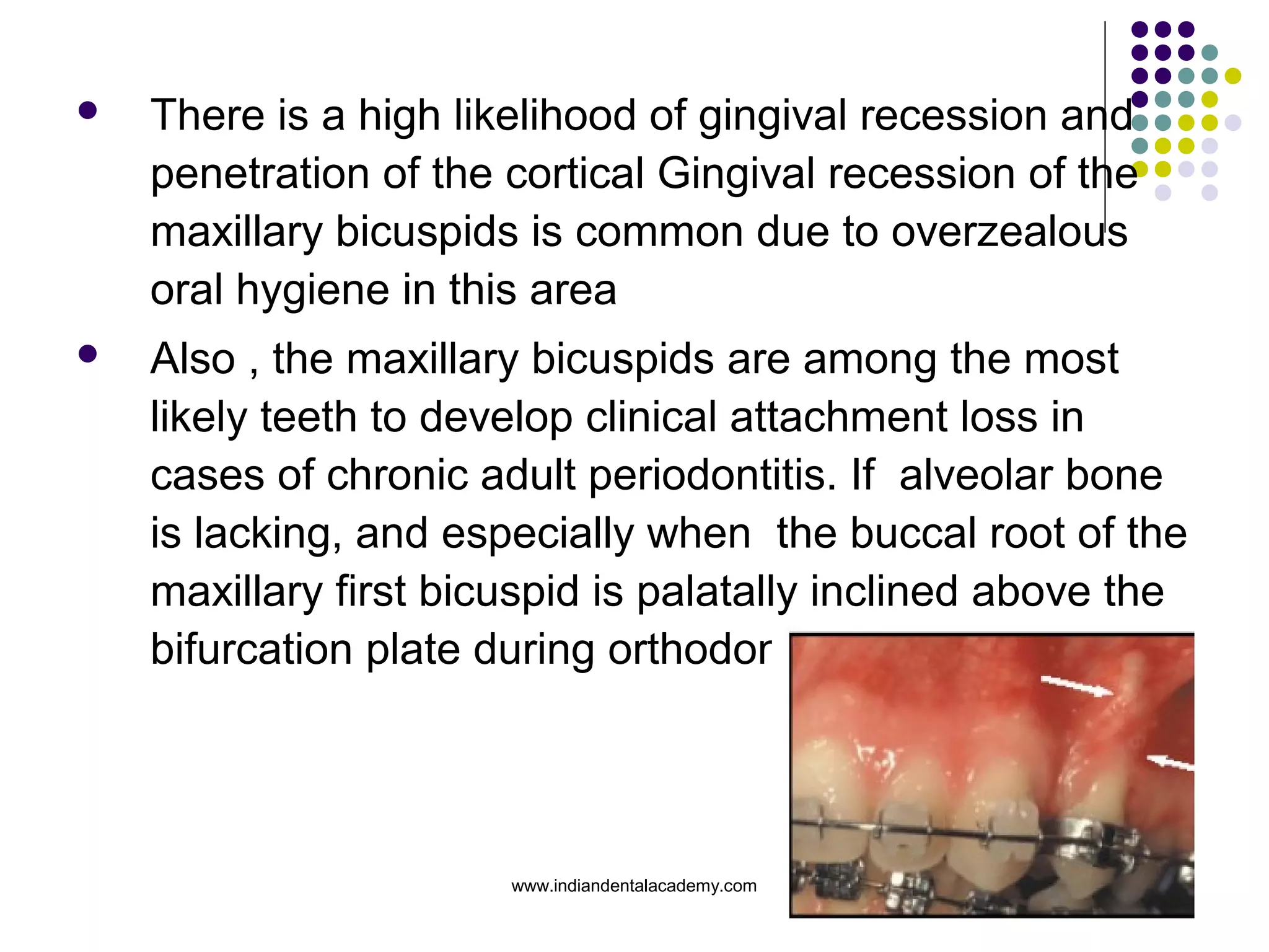 Palatal and buccal root torquing springs | PPT