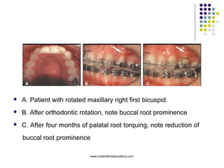 Palatal and buccal root torquing springs | PPT