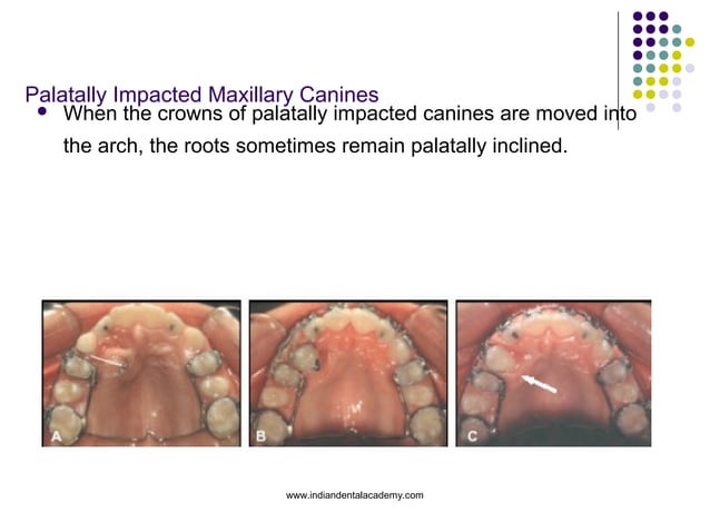 Palatal and buccal root torquing springs | PPT | Dental Health ...