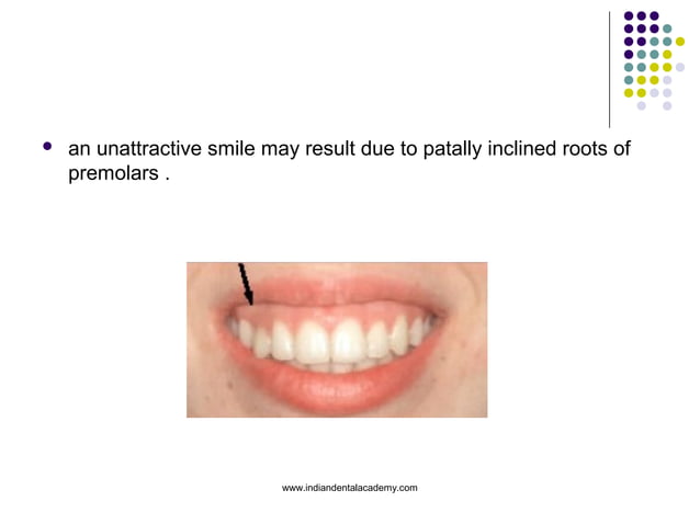Palatal and buccal root torquing springs | PPT | Dental Health ...