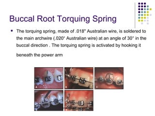 Palatal and buccal root torquing springs | PPT