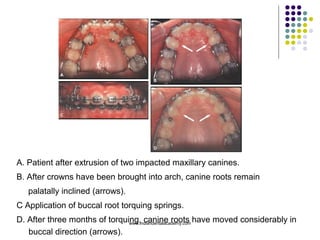 Palatal and buccal root torquing springs | PPT