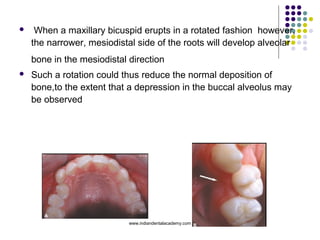 Palatal and buccal root torquing springs | PPT