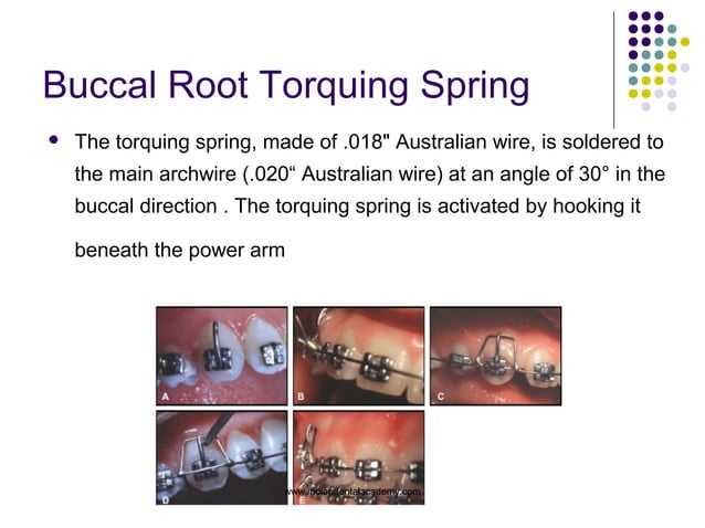Palatal and buccal root torquing springs | PPT