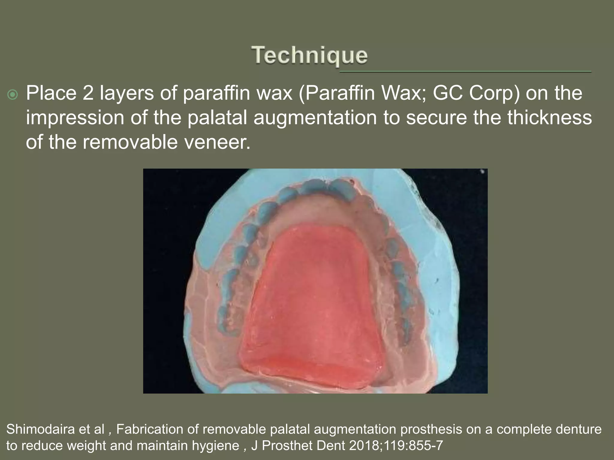 Removable Palatal Augmentation Prosthesis | PPTX