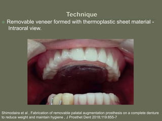 Removable Palatal Augmentation Prosthesis | PPTX
