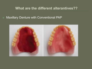 Removable Palatal Augmentation Prosthesis | PPTX