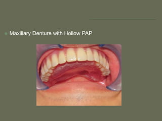 Removable Palatal Augmentation Prosthesis | PPTX