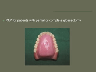 Removable Palatal Augmentation Prosthesis | PPTX