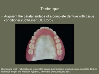 Removable Palatal Augmentation Prosthesis | PPTX