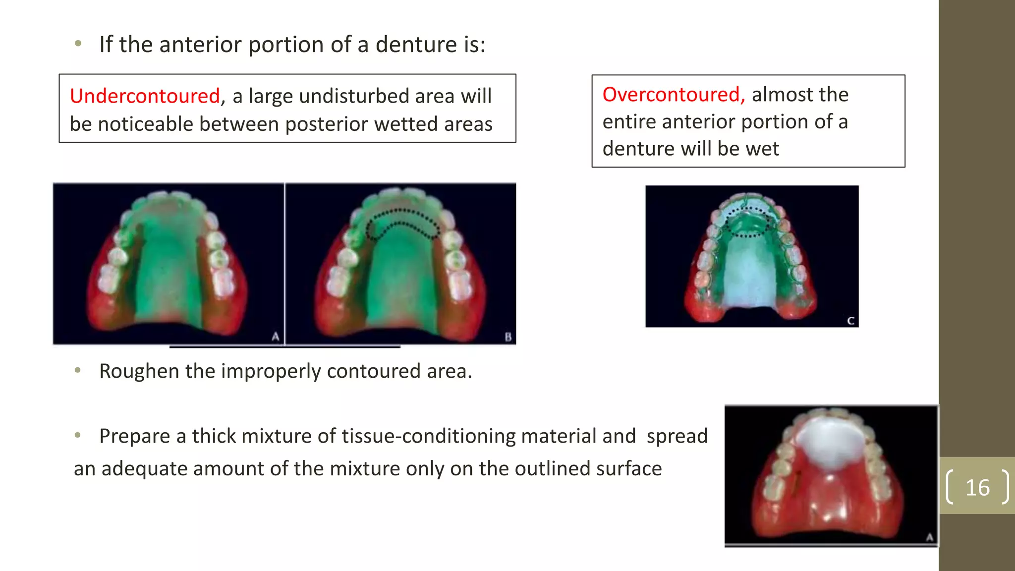 Palatal contours of denture | PPTX