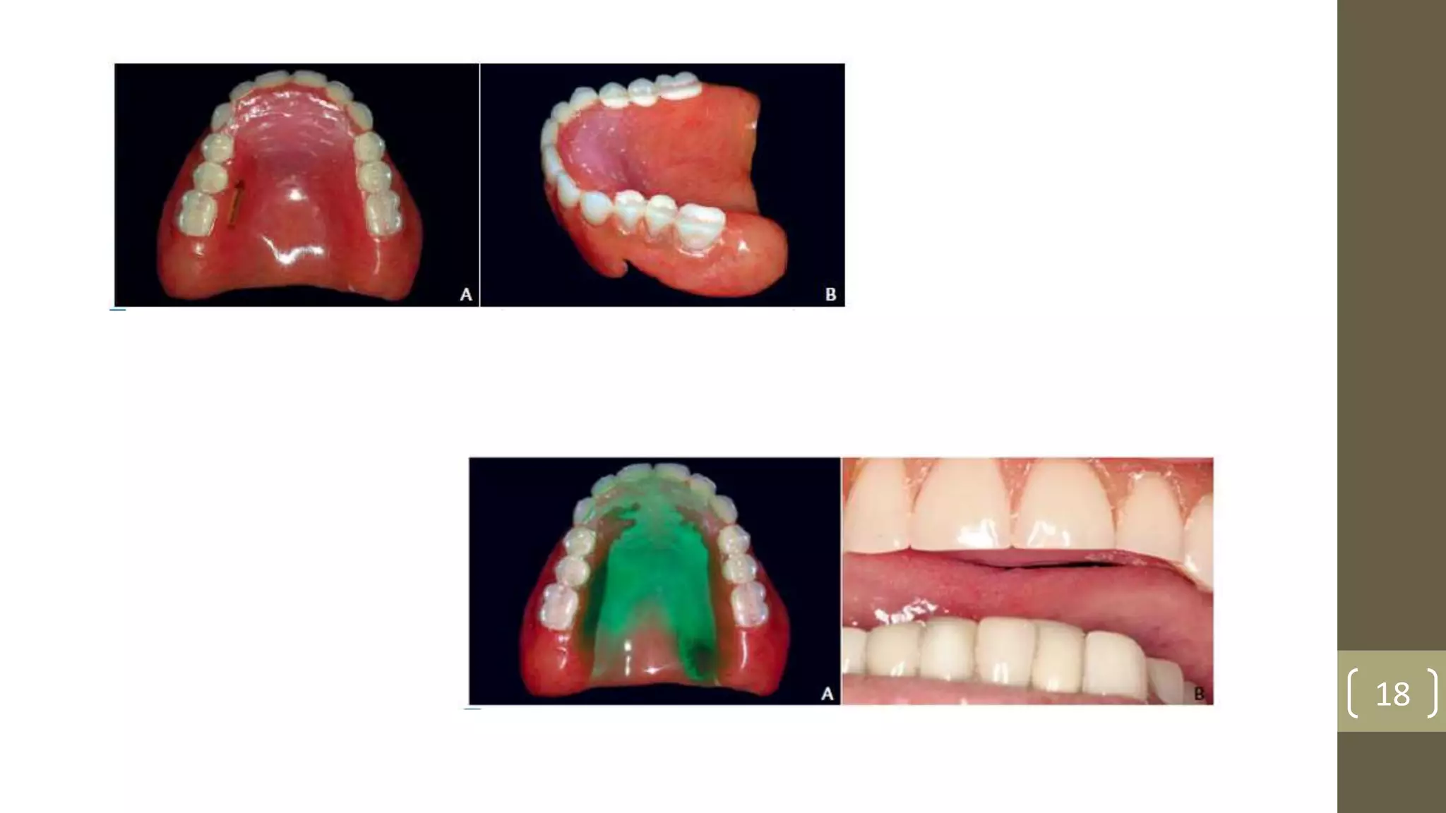 Palatal contours of denture | PPTX