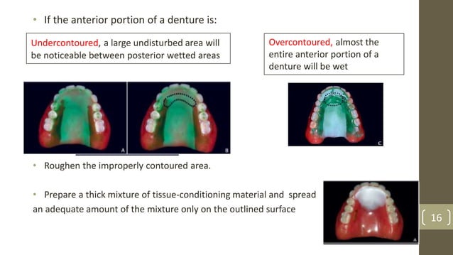 Palatal contours of denture | PPTX