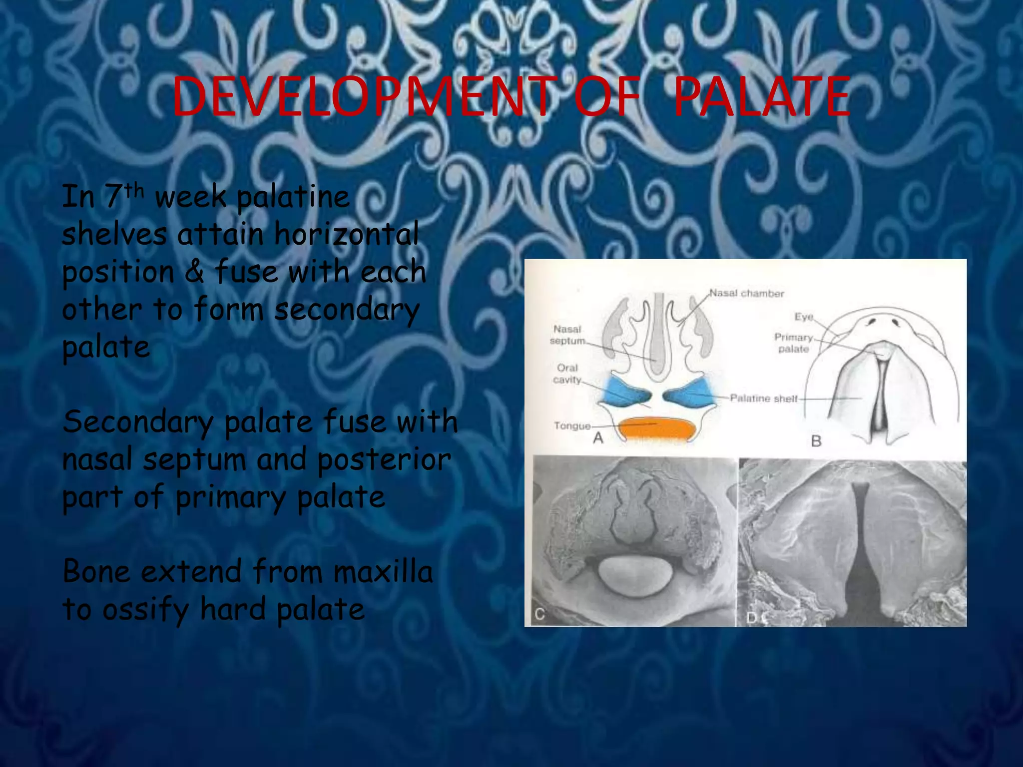 Palatal fistula and syndromes associated with clcp part 1 by Dr. Amit ...