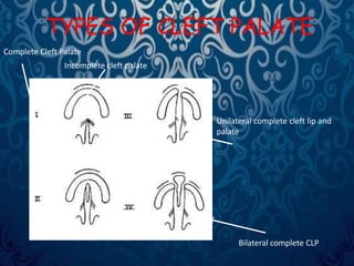 Palatal fistula and syndromes associated with clcp part 1 by Dr. Amit ...