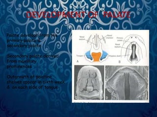 Palatal fistula and syndromes associated with clcp part 1 by Dr. Amit ...