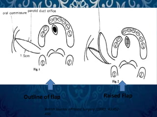 Palatal fistula and syndromes associated with clcp part ii by Dr. Amit ...