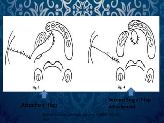 Palatal fistula and syndromes associated with clcp part ii by Dr. Amit ...