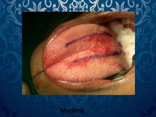 Palatal fistula and syndromes associated with clcp part ii by Dr. Amit ...