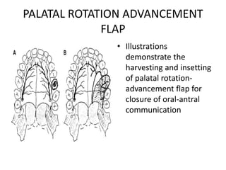 Palatal island flap | PPTX