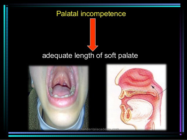 Palatal lift prosthesis/ orthodontic straight wire technique