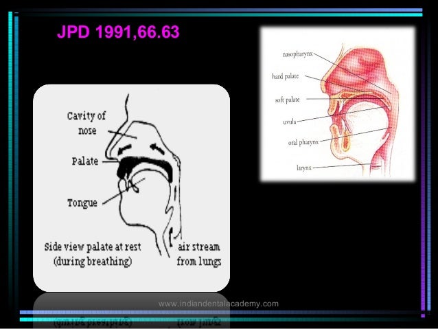 Palatal lift prosthesis/ orthodontic straight wire technique