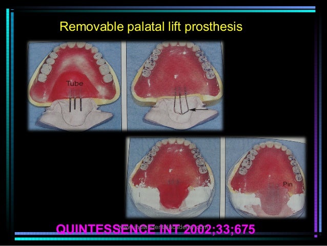Palatal lift prosthesis/ orthodontic straight wire technique