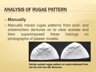 Palatal rugae | PPTX