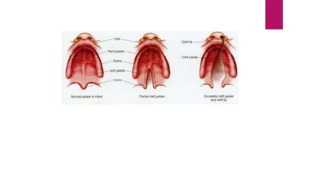 Palate , by dr.parthsarthi gautam, MDS
