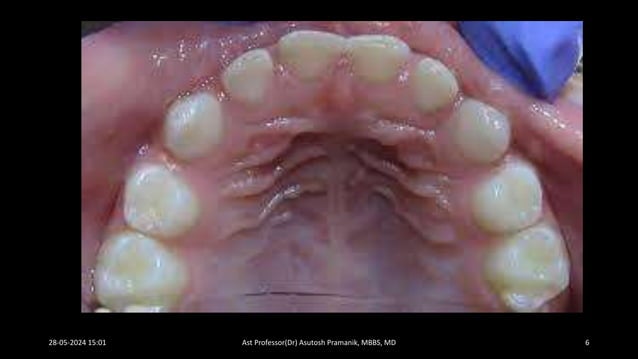 the palate - hard palate and soft palate | PPT