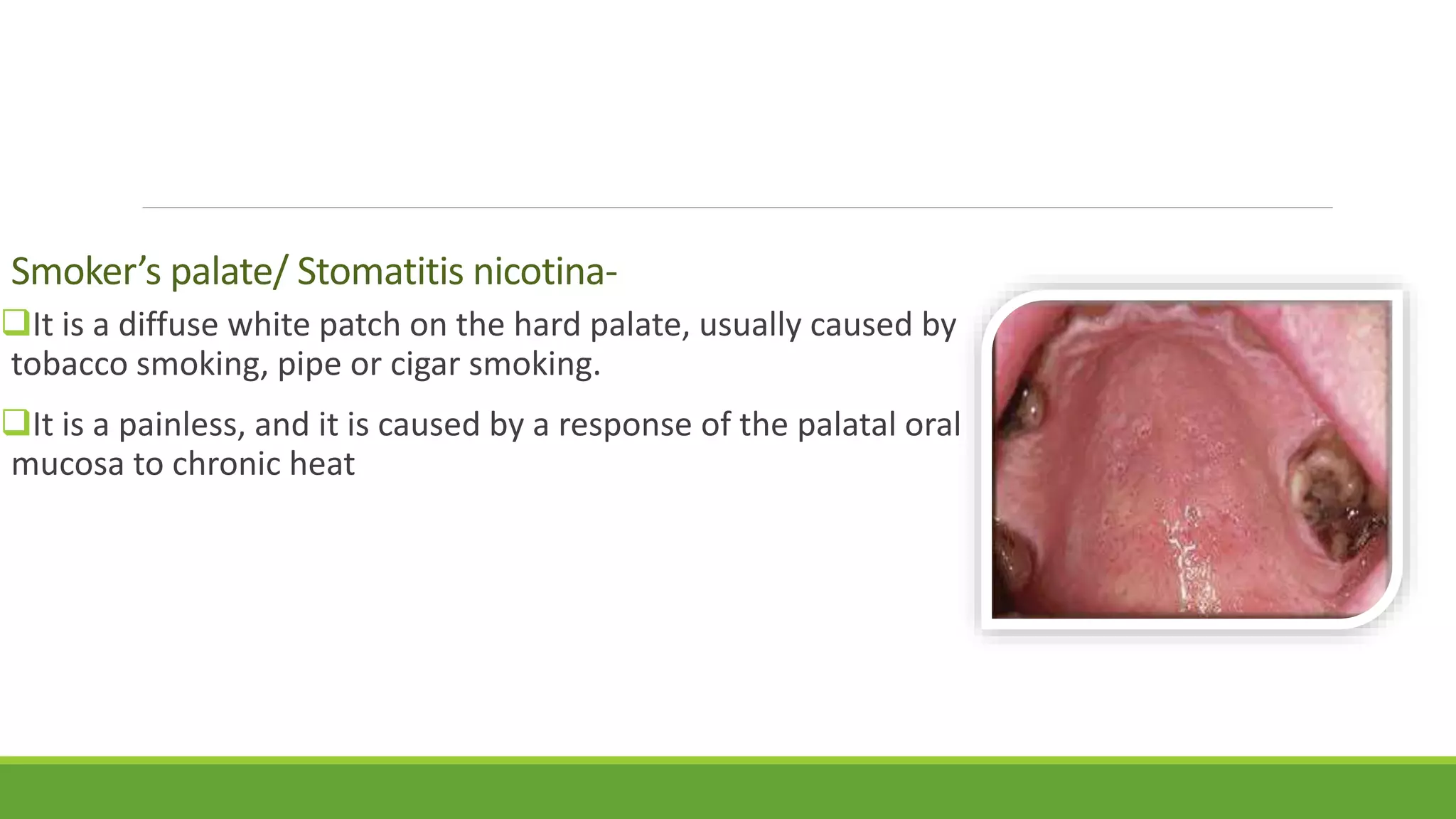 palate anatomy | PPTX