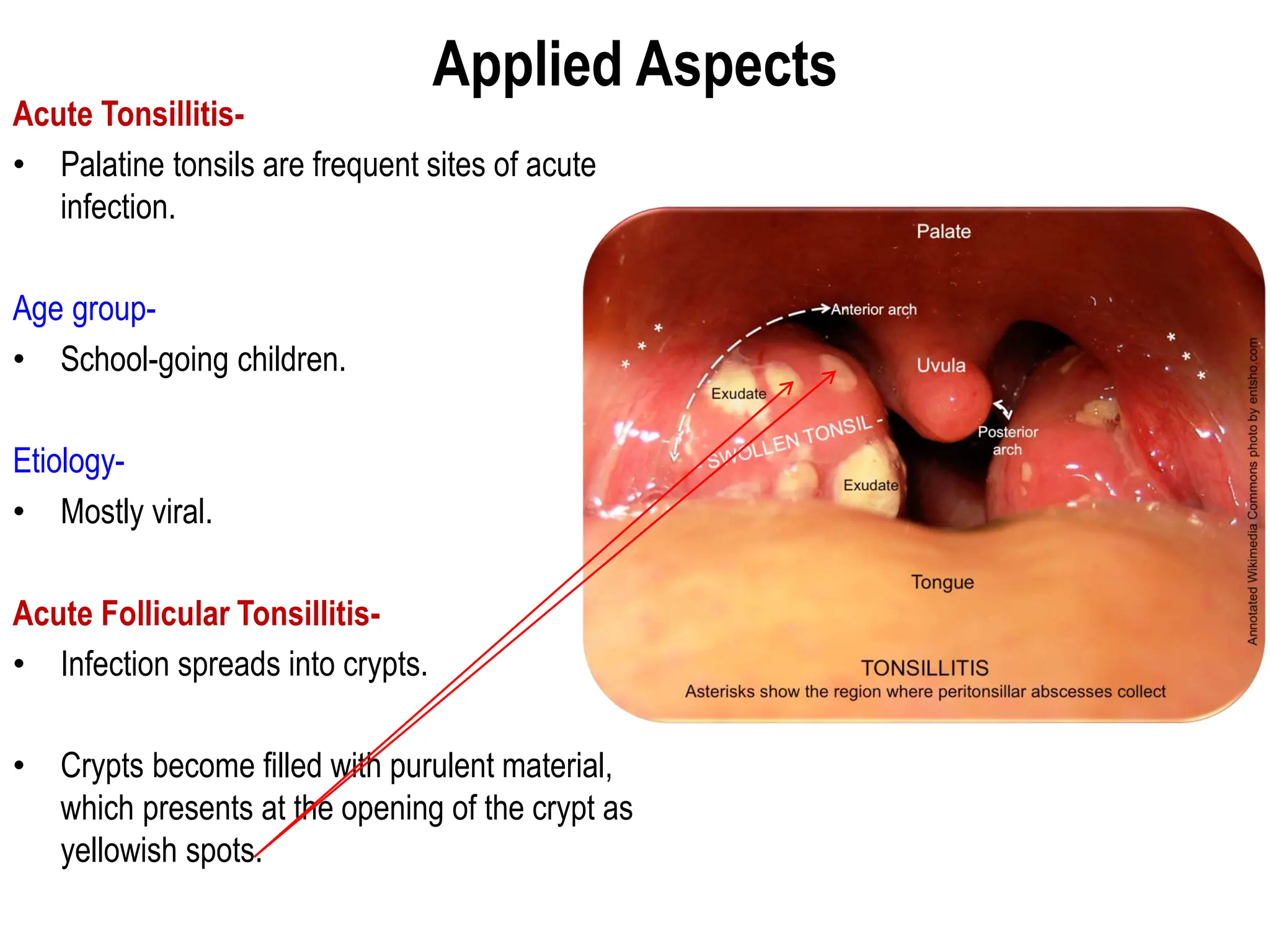 PALATINE-TONSILS Anatomy and applied aspectspresentation | PDF