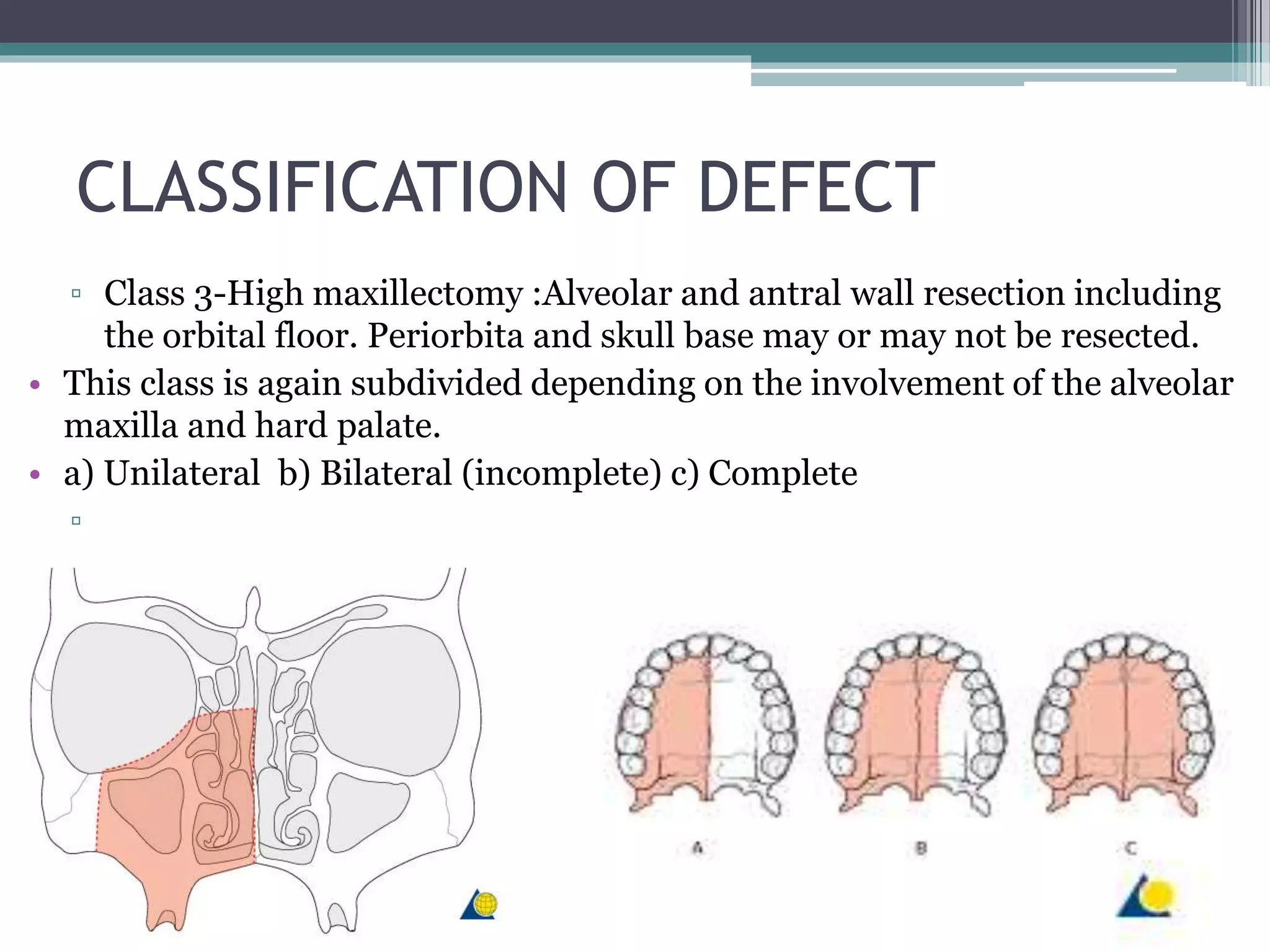 Palato maxillary reconstruction | PPTX