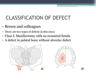 Palato maxillary reconstruction | PPTX