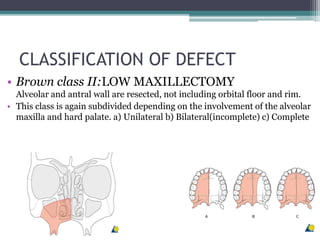Palato maxillary reconstruction | PPT