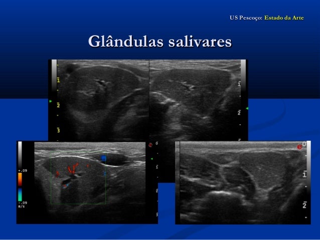 Ultrassom De Cálculo De Glândula Submandibular