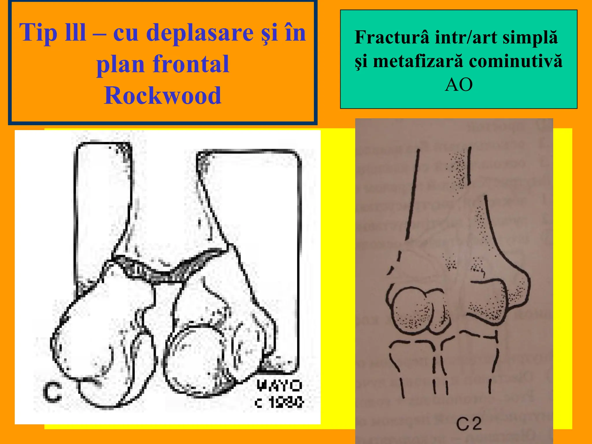 Paleta humerala-2008 Clasificare_1-2.ppt