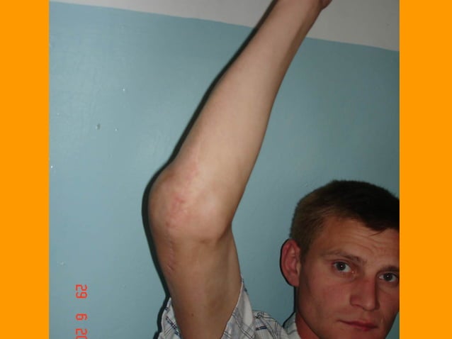 Paleta humerala-2008 Clasificare_1-2.ppt