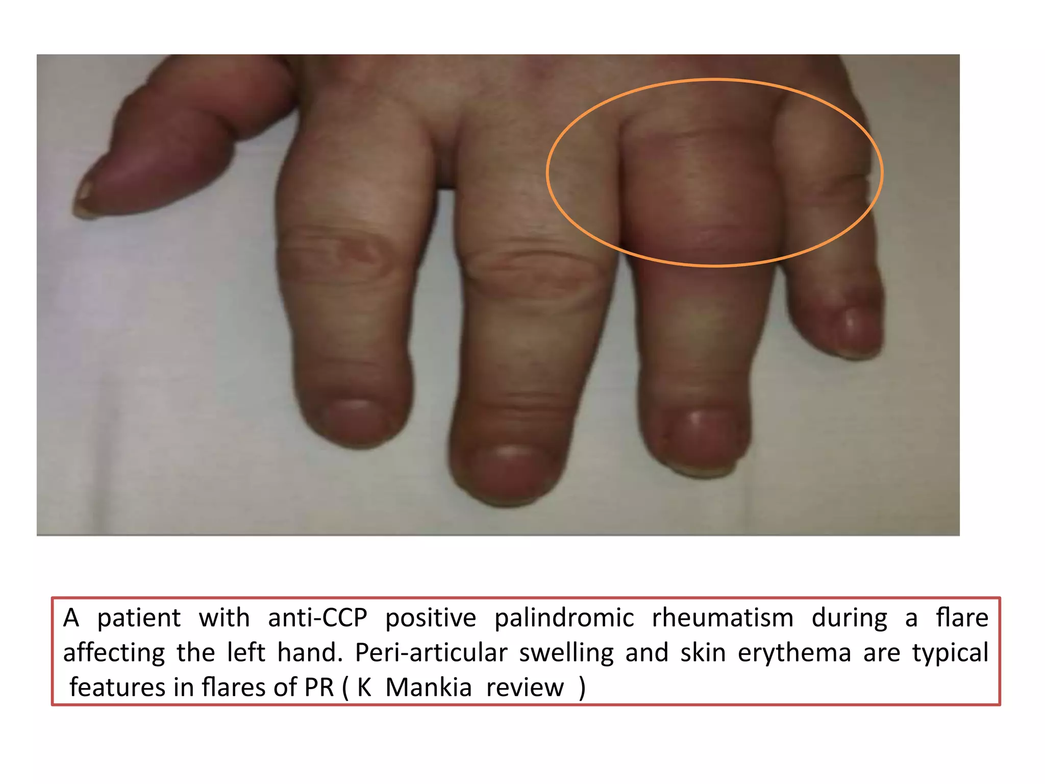 Palindromic rheumatrism.pptx