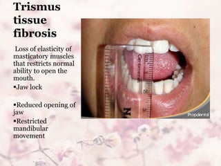 Management of oral problem in Palliative care setting | PPTX