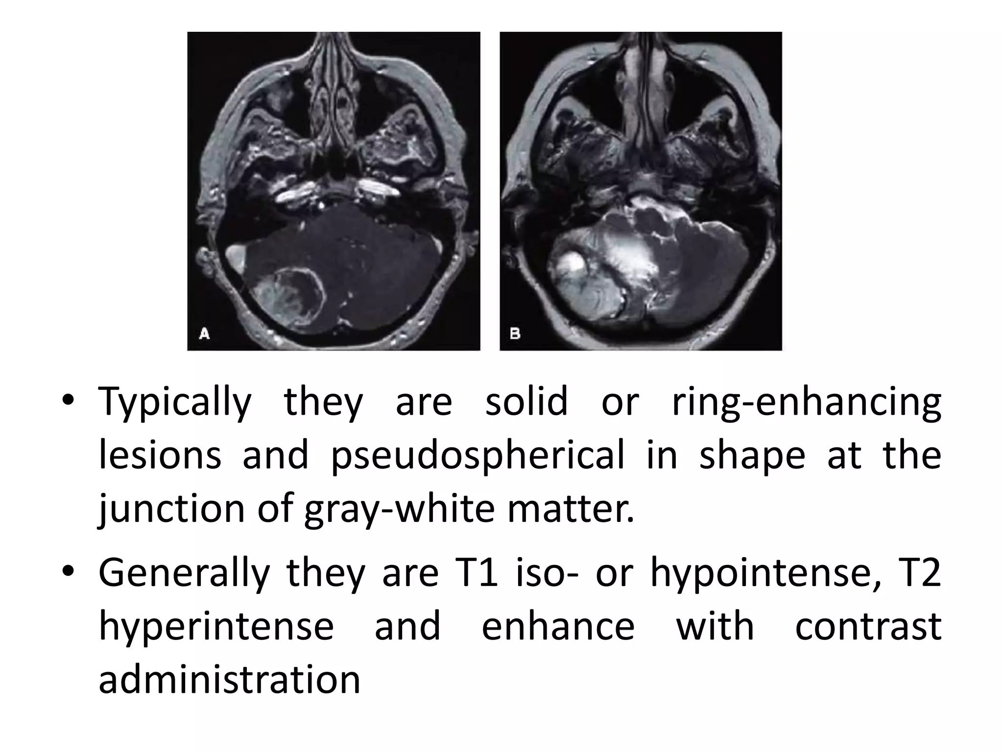 Palliation brain, spinal and bone mets | PPTX