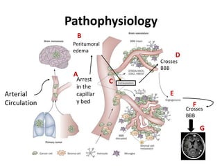 Palliation brain, spinal and bone mets | PPTX