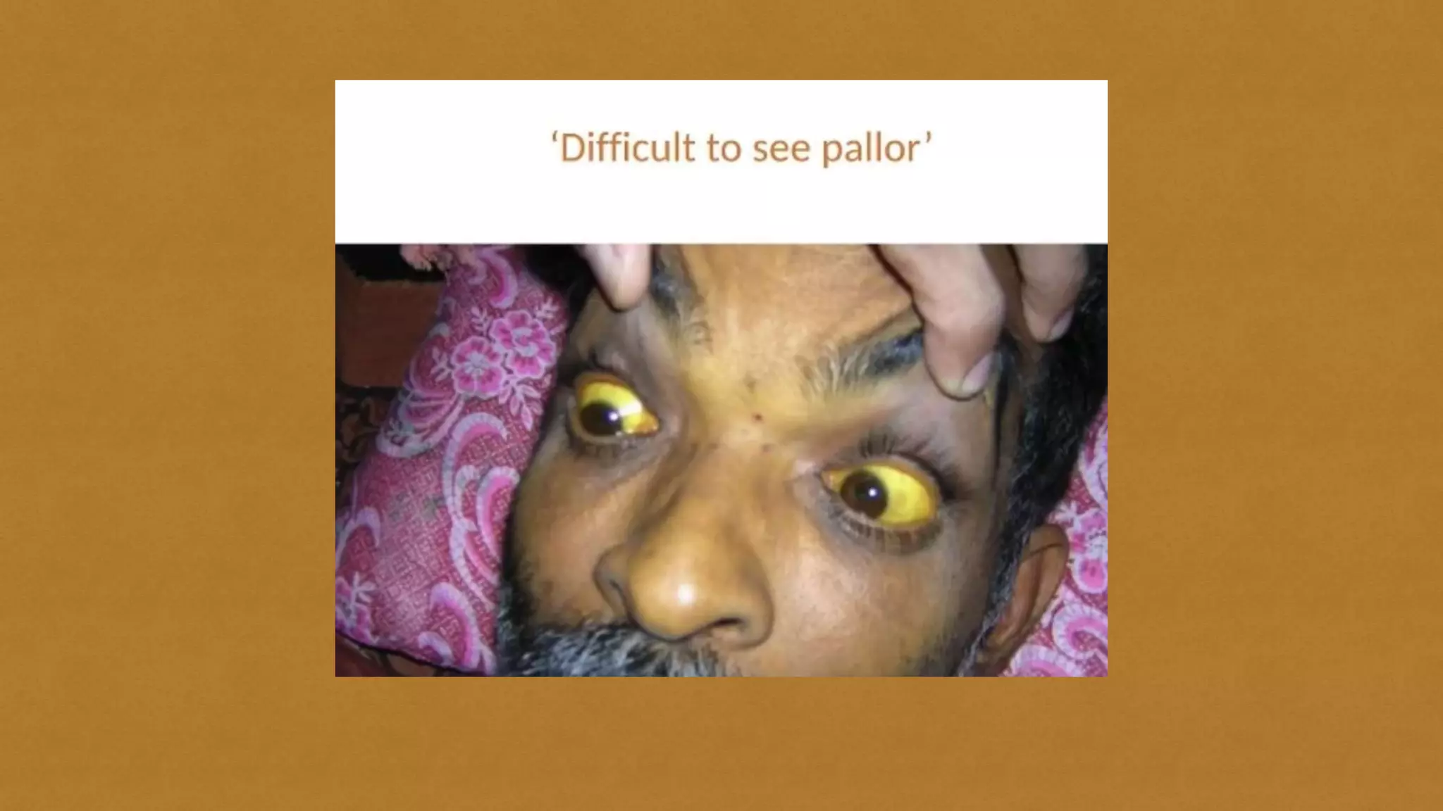 Pallor | PPTX