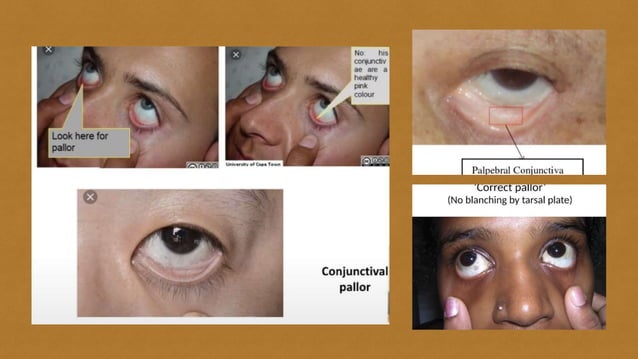 Pallor | PPTX | Blood Disorders | Diseases and Conditions