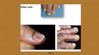 Pallor | PPTX