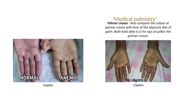 Pallor | PPTX | Blood Disorders | Diseases and Conditions
